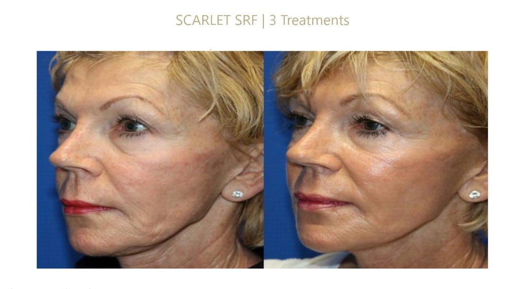 Before and After Photos for RF Microneedling with ScarletRF
