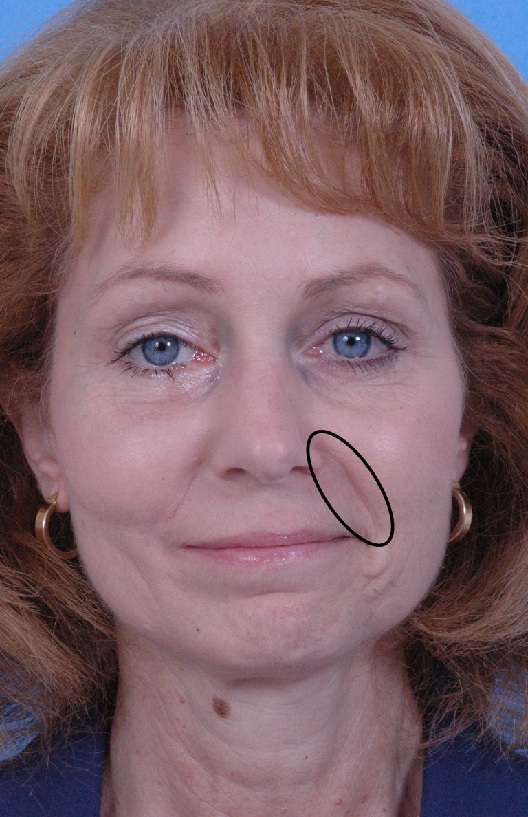 Nasolabial Fold Filler Near Me | Specials, Cost